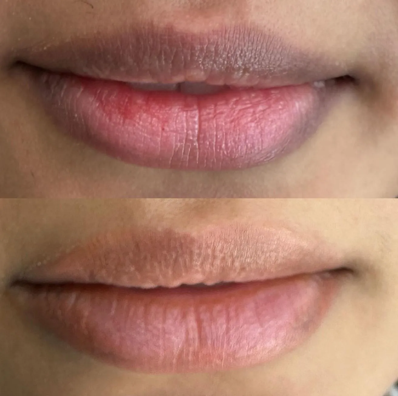 Reduce Swelling After Lip Tattoo